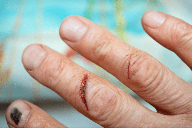 The Ultimate Guide to Preventing Cuts and Lacerations at Work - Metro ...